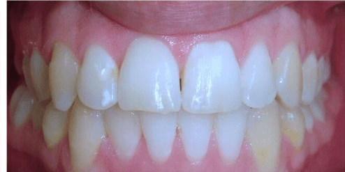 Oclusión dental | Clínica Odontológica Carrera