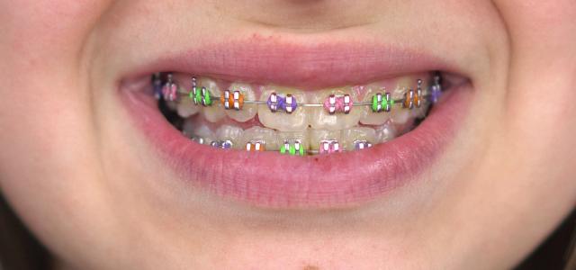 Brackets estéticos ¿Qué son y cuántos tipos hay? 👄| Clínica ...
