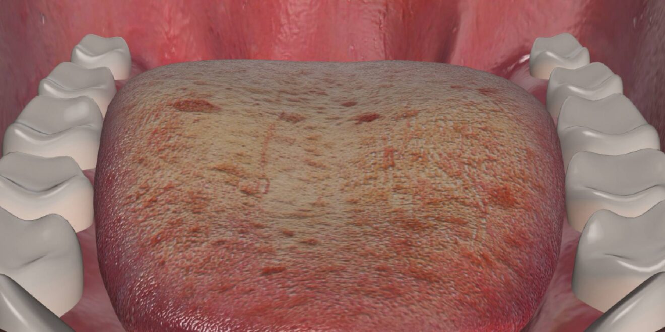 Candidiasis Bucal | Clínica Odontológica Carrera